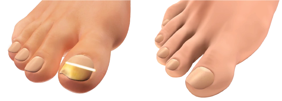 OnycoStop Pro Nailner | VOLLEDIGE ZORG VOOR JOUW VOETEN